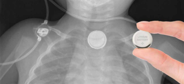 Button batteries - a little known danger in your home that can cause ...